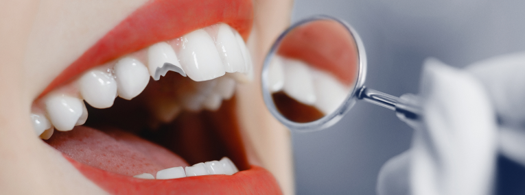 🆘 Zahn abgebrochen: Erste Hilfe & Behandlung | dentolo