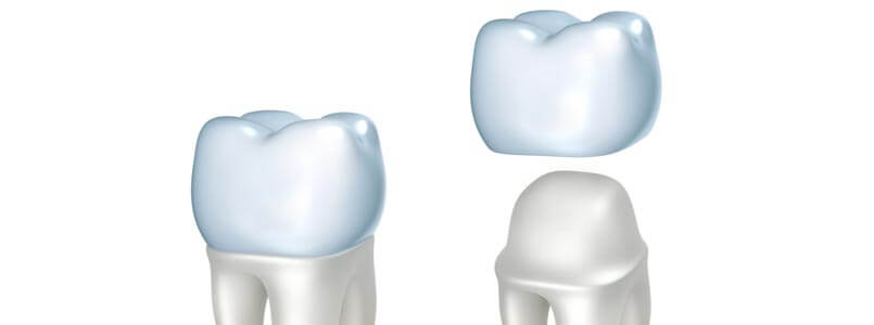 Keramikkrone: Die ästhetische, allergiefreie Krone | dentolo